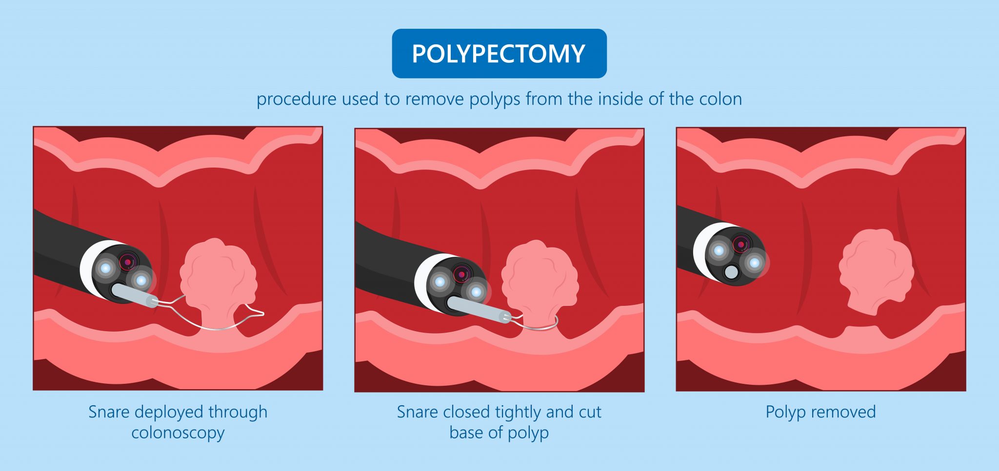 Colonoscopy Screening Clinic Singapore | Colorectal Cancer Screening