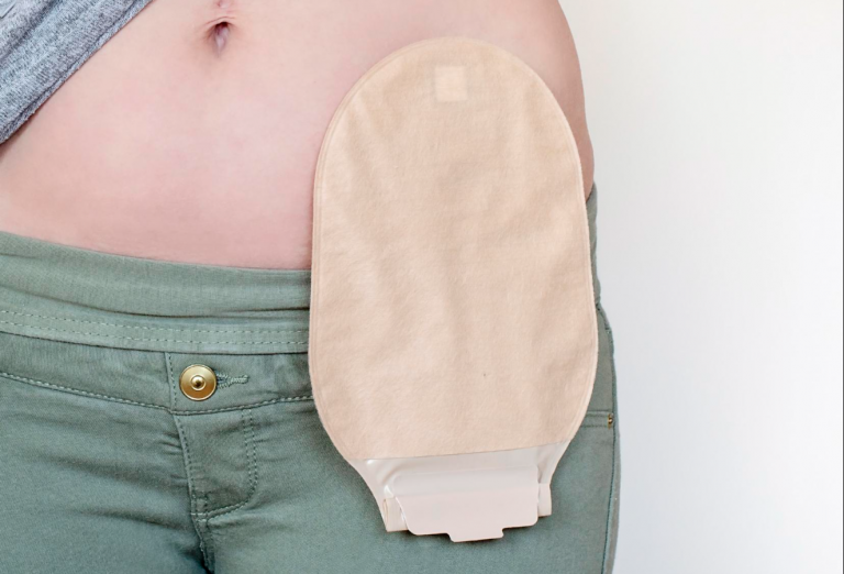 Ostomy Bag Vs Colostomy Bag: 3 Differences And Essential Tips